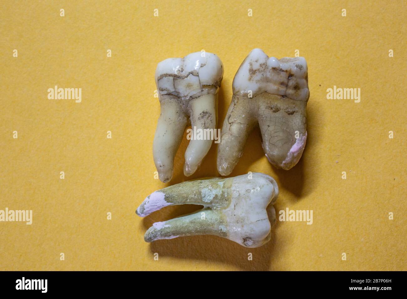 Roots Of Teeth Stock Photos & Roots Of Teeth Stock Images - Alamy