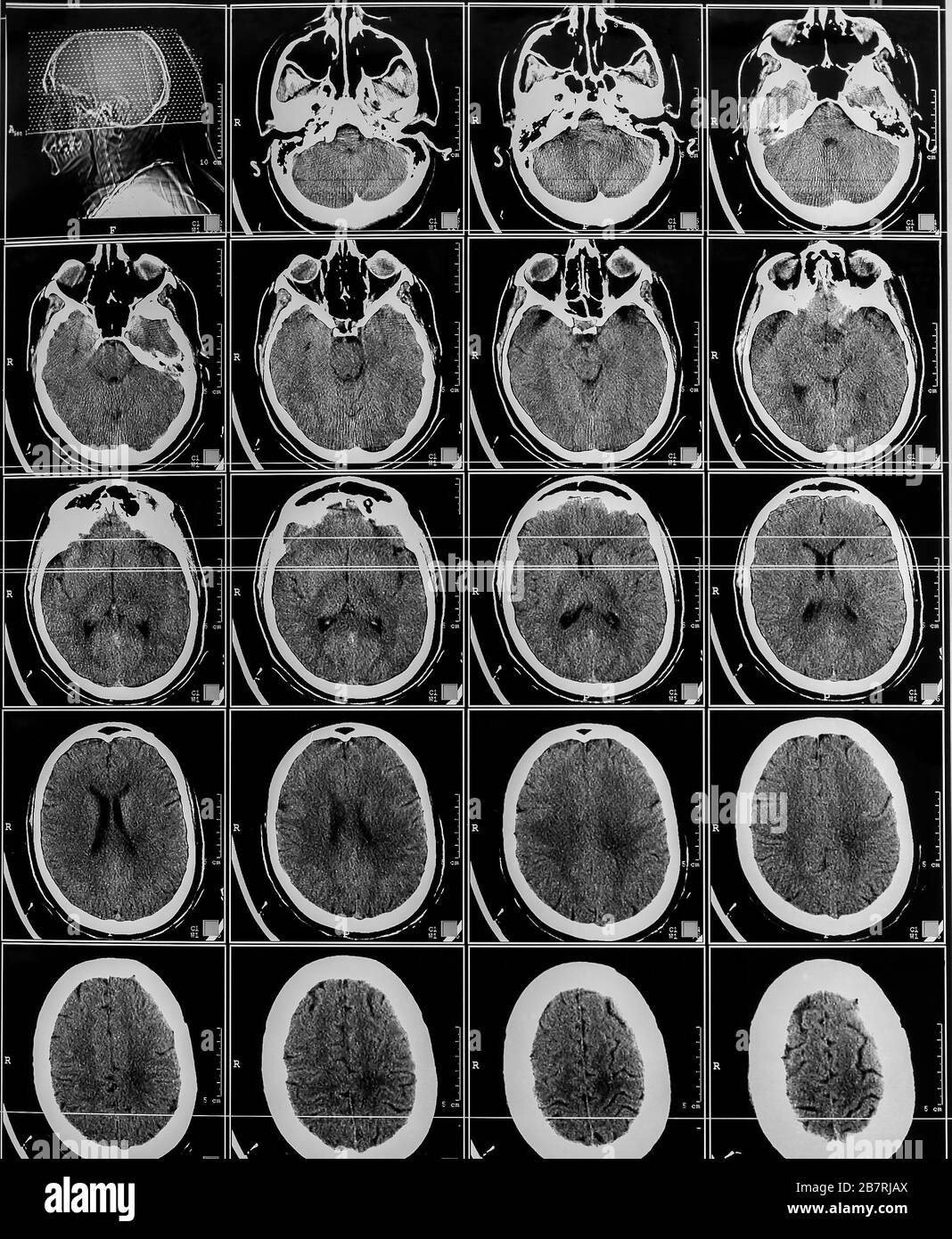 Electromagnetic Tomography Brain. Sequence of vertical sections of a ...