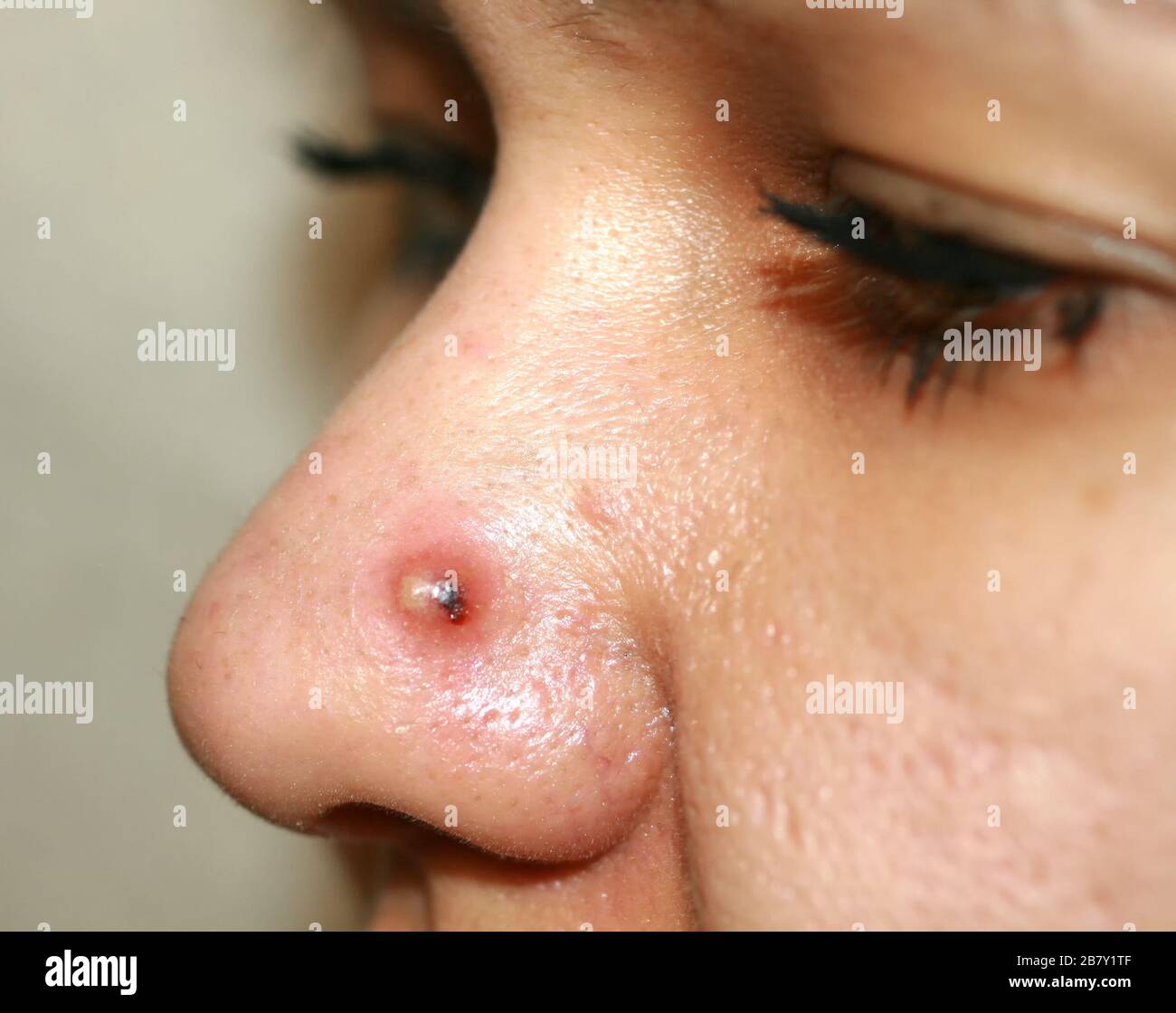 Big pimple on nose store