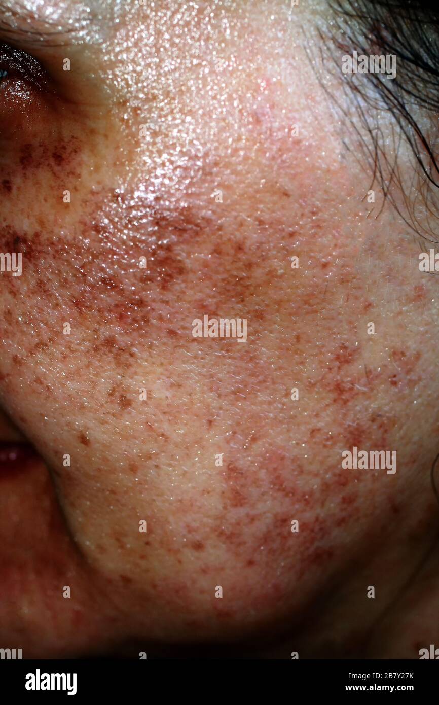Pigmented spots on the face. Pigmentation on cheeks Stock Photo - Alamy