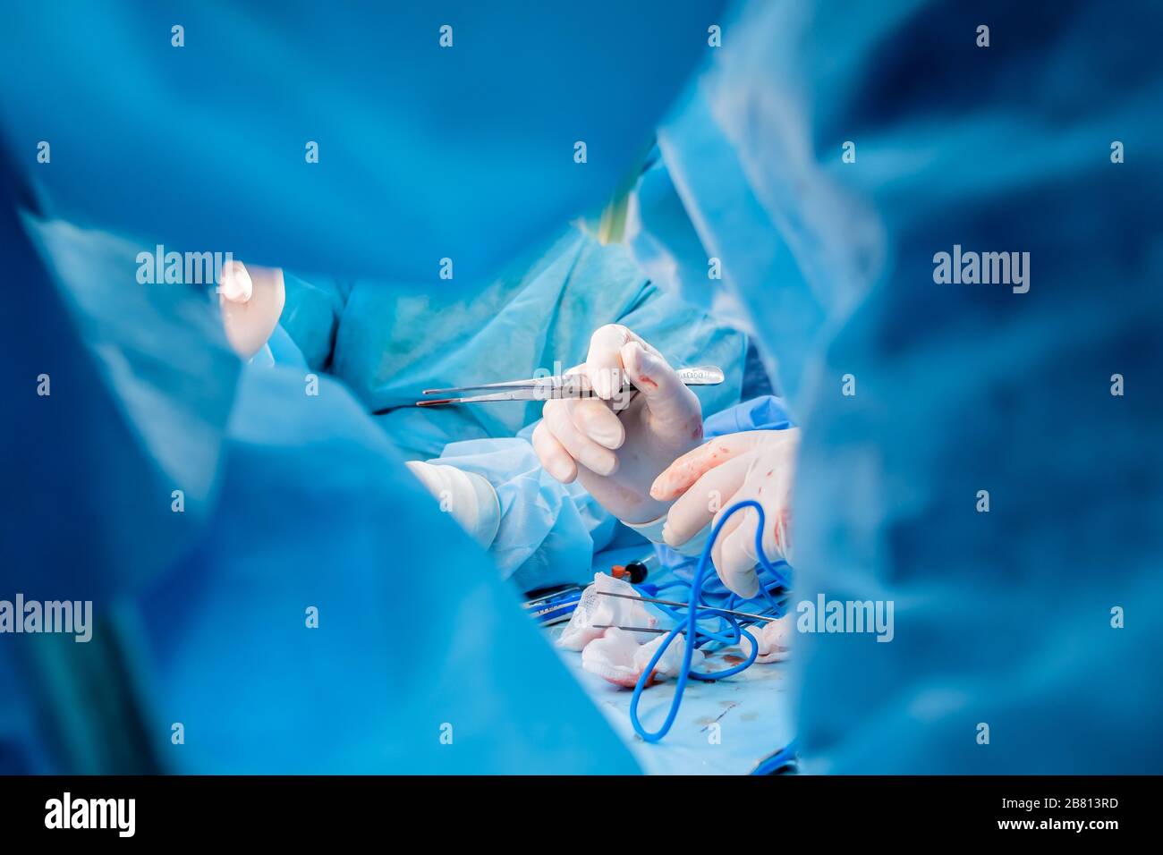 Hemorrhoids Operation