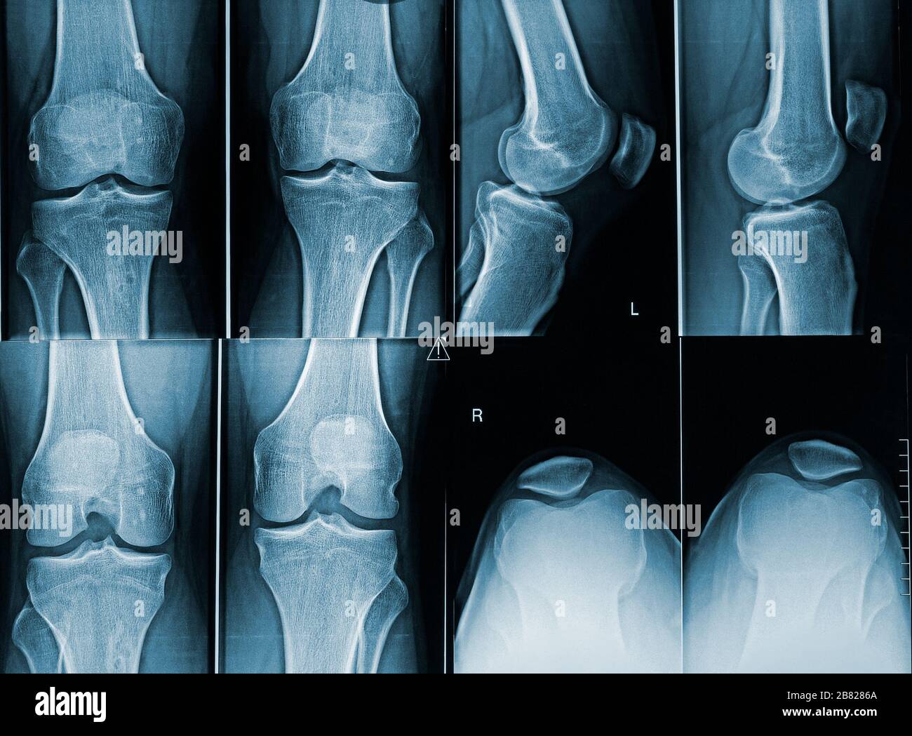 Knee Xray Anatomy Anatomy Of The Knee (CT Arthrography) | E Anatomy