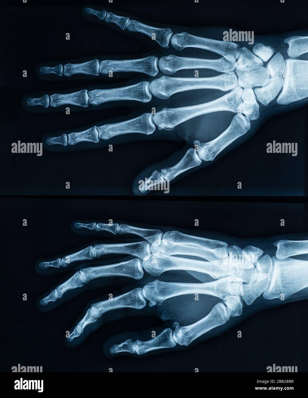 Ray Of Hand Bones Right Hands | Radiology Reference Article