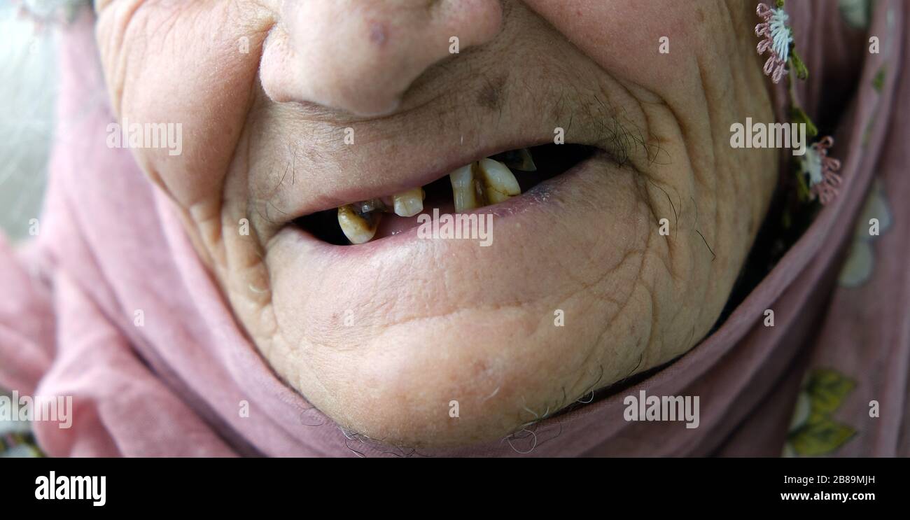 old woman with spilled teeth Stock Photo - Alamy