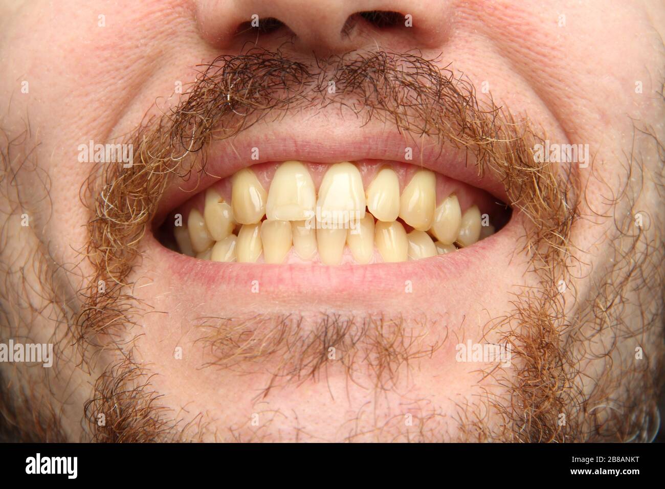 Dirty teeth hi-res stock photography and images - Alamy