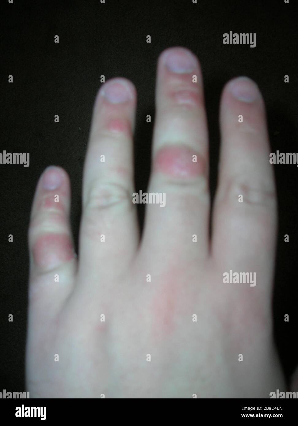 Dermatillomania hi-res stock photography and images - Alamy