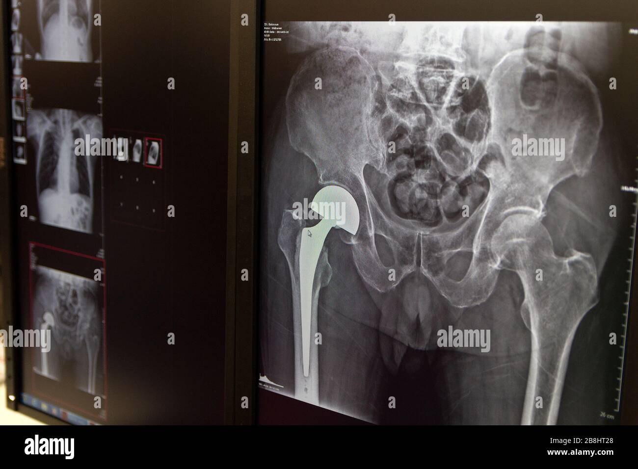 X-ray of the hip prosthesis elderly man Stock Photo - Alamy