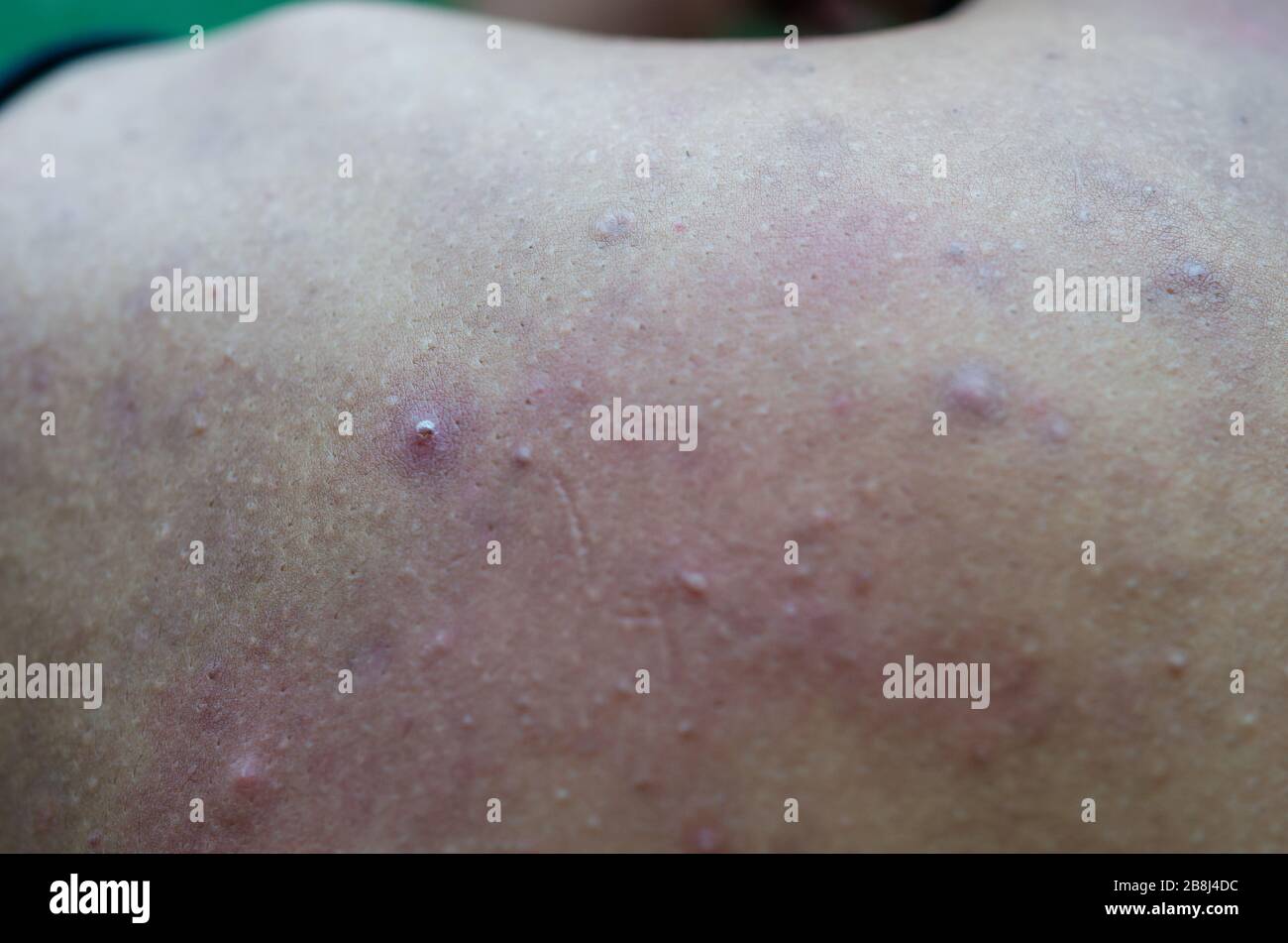 Asian teen boy Inflammatory acne on the back Stock Photo - Alamy