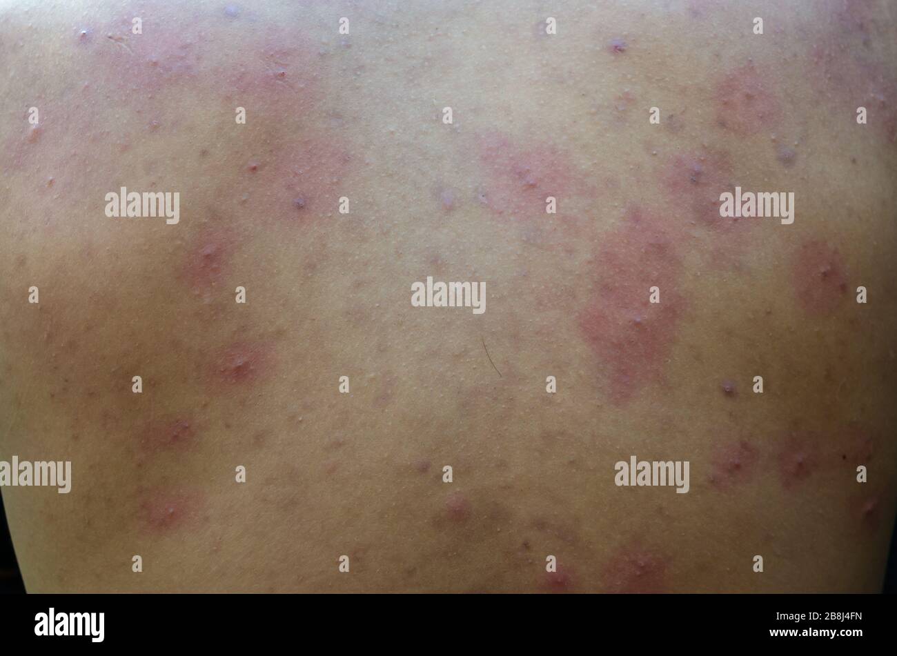Asian teen boy Inflammatory acne on the back Stock Photo - Alamy