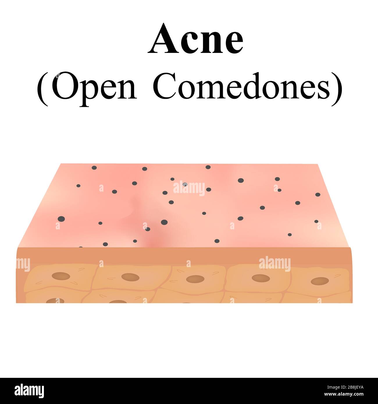 Open comedones. Acne on the skin. Dermatological and cosmetic diseases ...