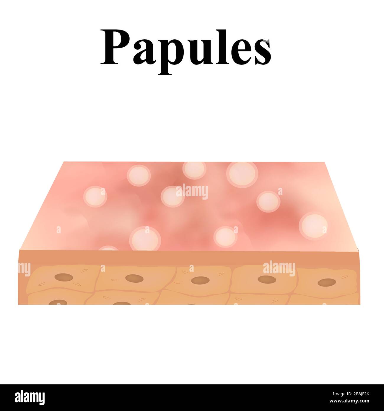 Papules. Acne on the skin. Dermatological and cosmetic diseases on the ...