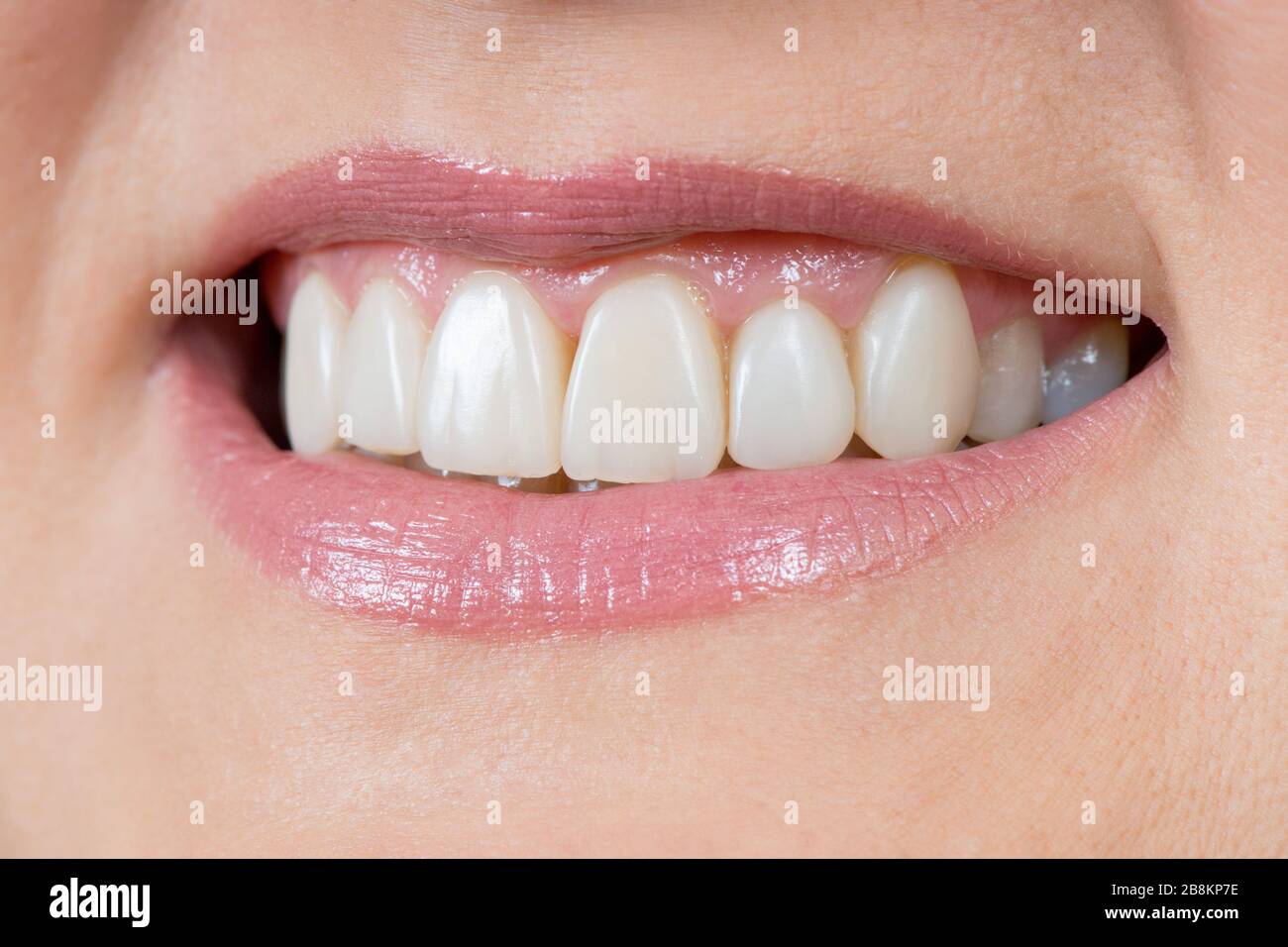 Woman smile. Teeth restoration. Dental care. Macro Stock Photo - Alamy