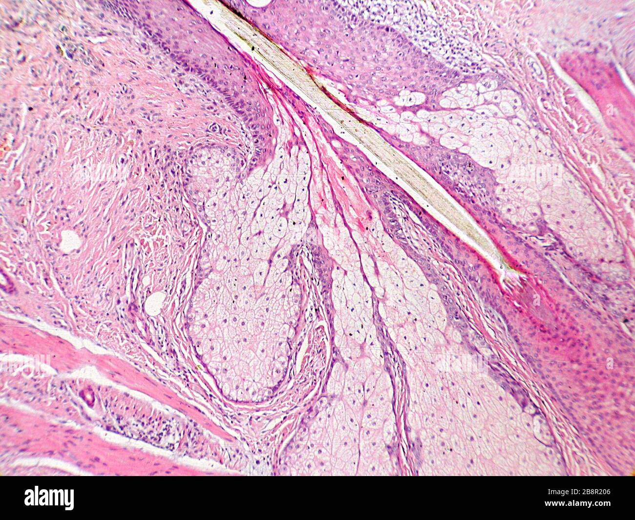 Intradermal nevus hi-res stock photography and images - Alamy