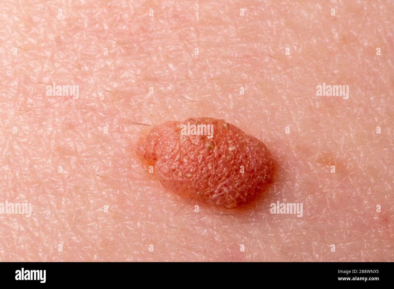 Large mole close-up. Macro shot of benign skin lesion on caucasian ...