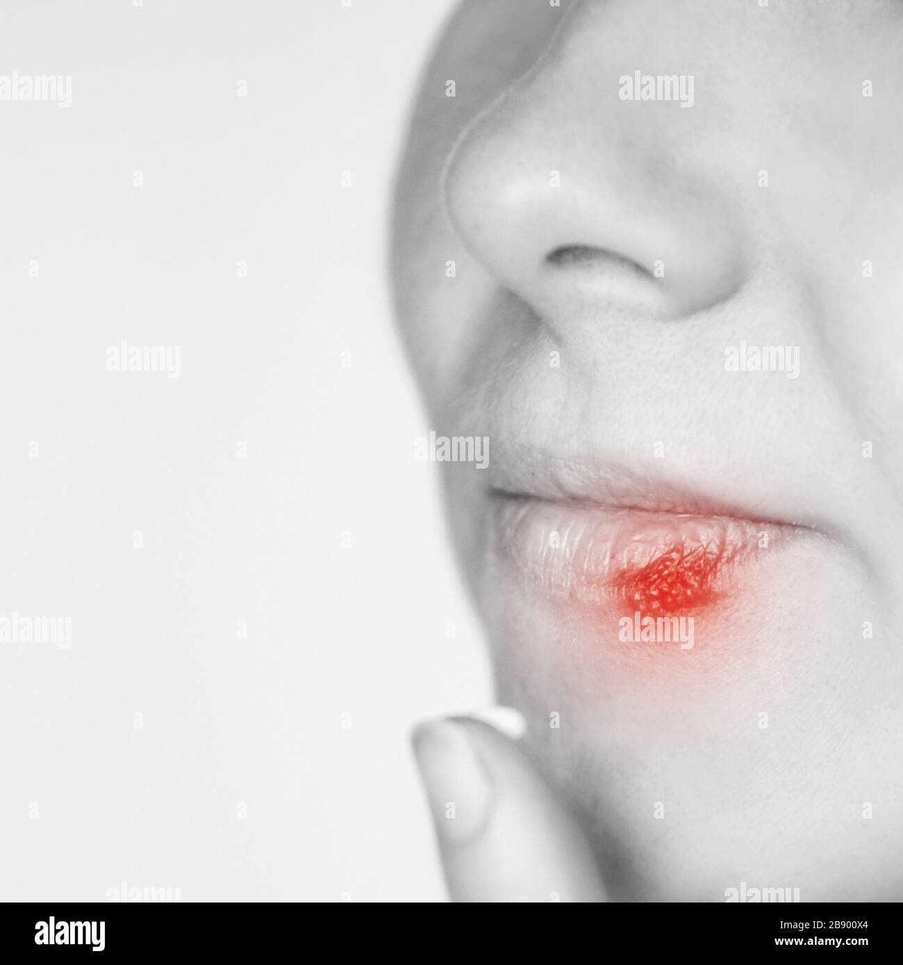 Girl with herpes. Sick symptom. Lips cold Stock Photo - Alamy