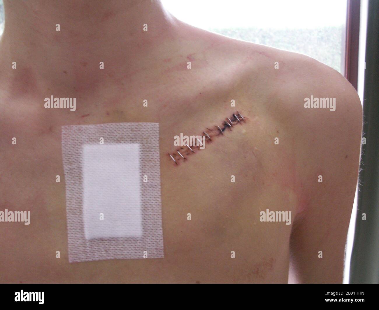Pacemaker implant hi-res stock photography and images - Alamy