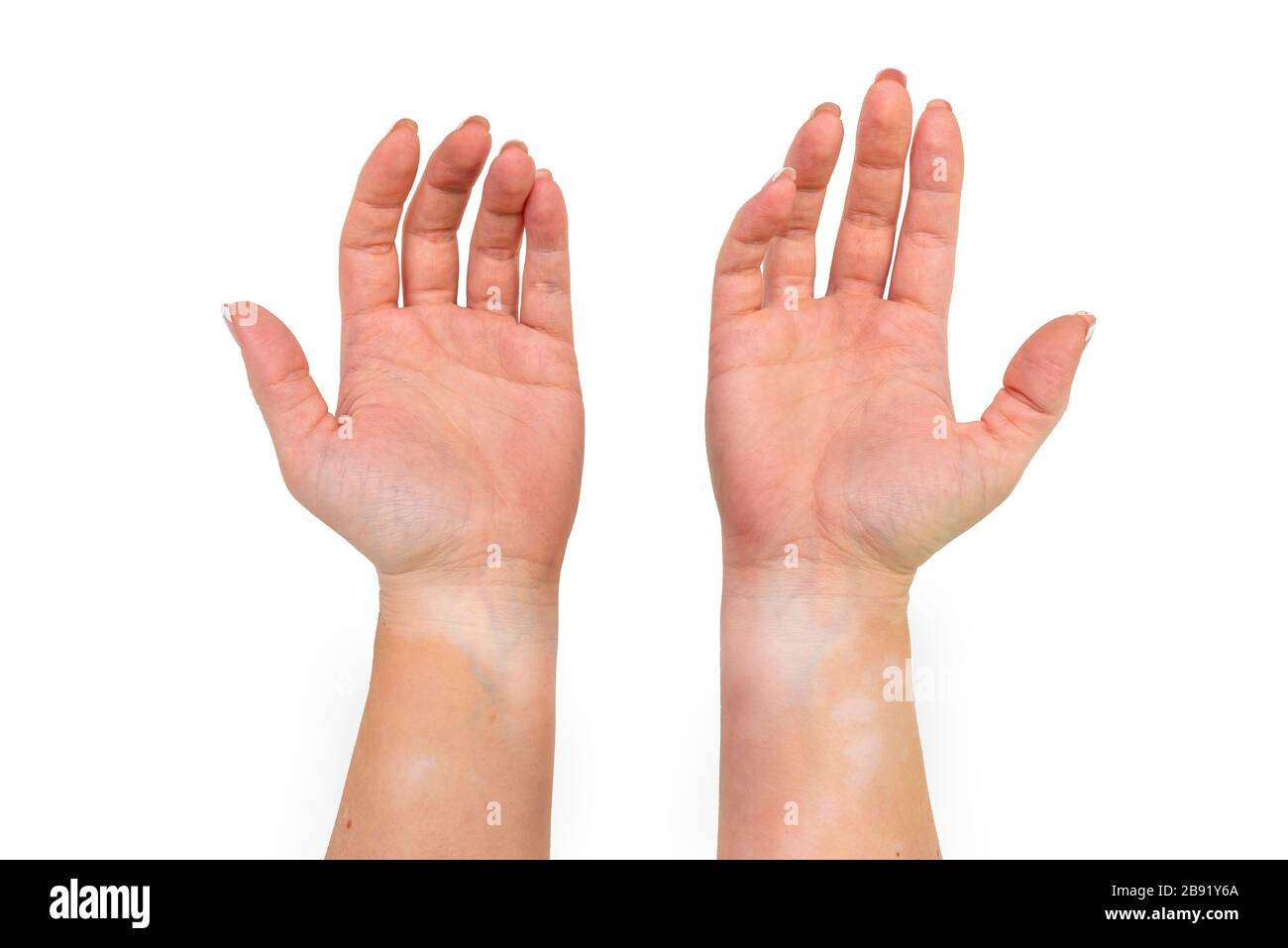 Stains from vitiligo disease on the inside of the hands and forearms of ...