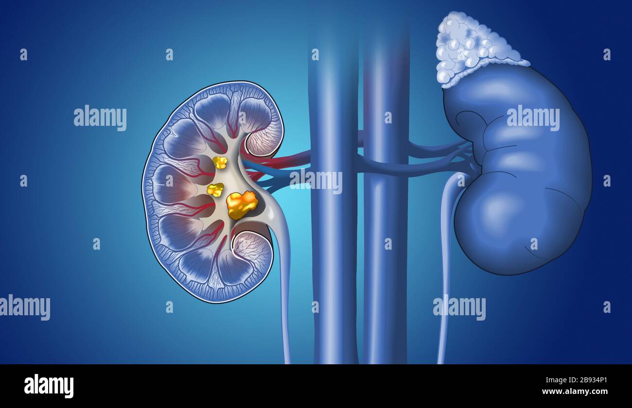 Medically Illustration showing kidney stones in minor and major calyces ...