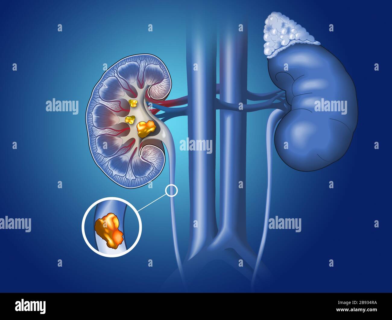 Medically Illustration showing kidney stones in minor and major calyces ...