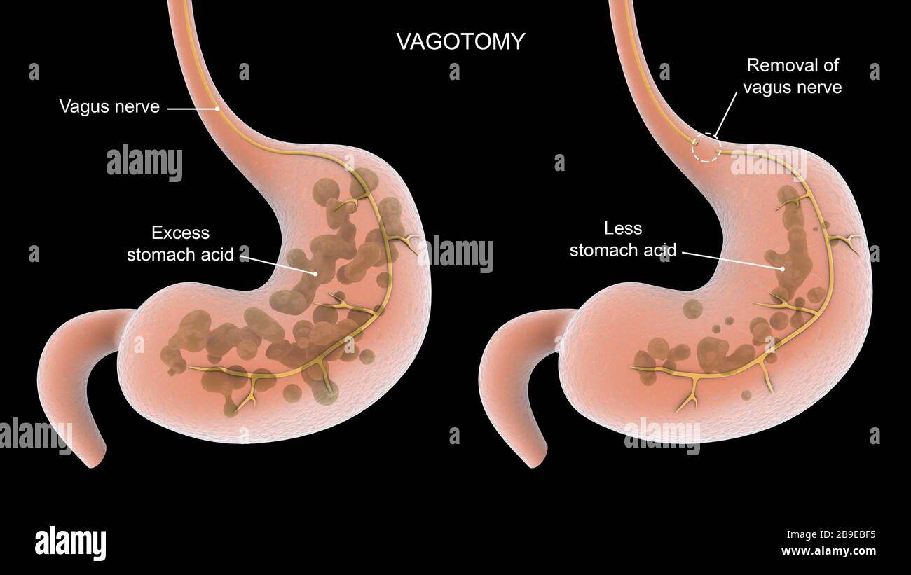 VagotomÃ­a