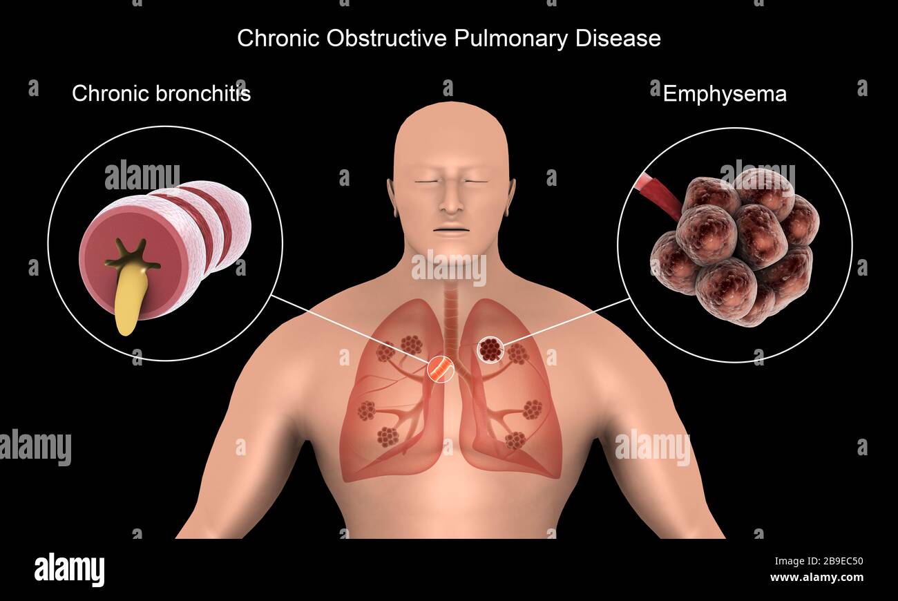 Chronic Obstructive Pulmonary Disease (COPD Stock Photo - Alamy