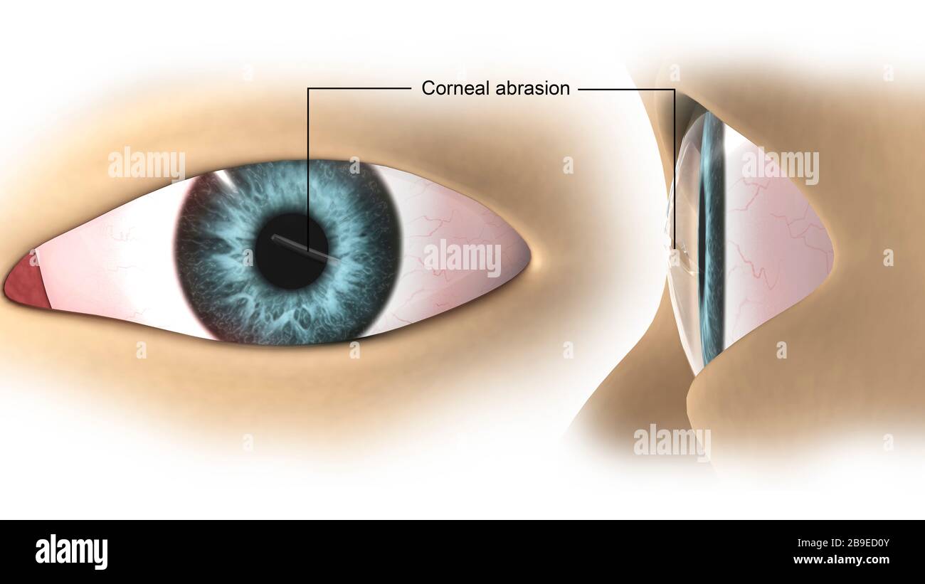 Cut On Cornea Of Eye