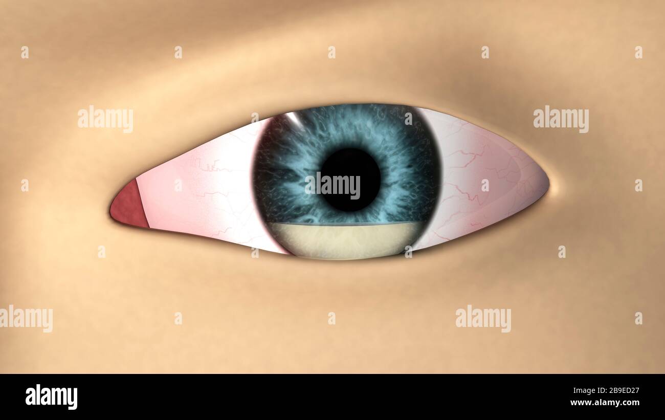 Medical illustration of endophthalmitis on the interior of the eye ...