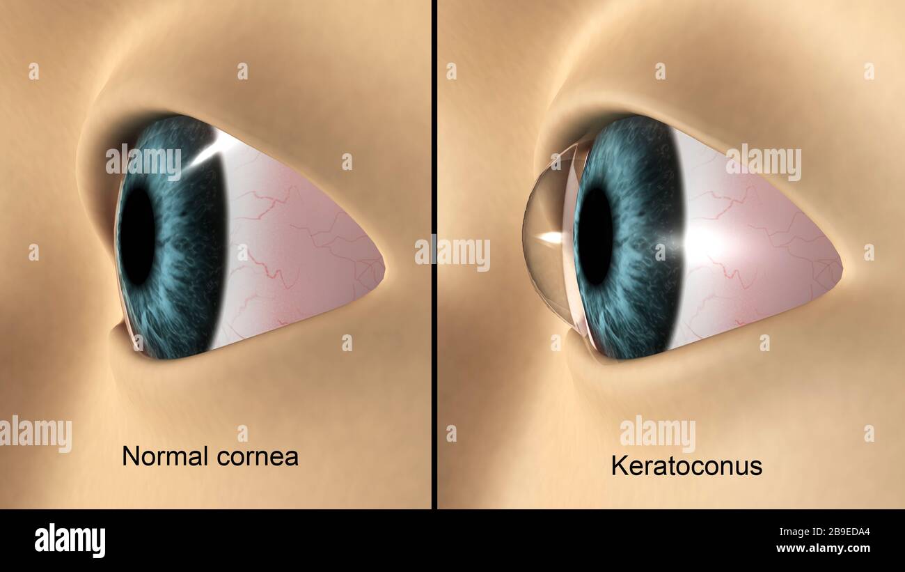 Medical illustration showing keratoconus in the eye Stock Photo - Alamy