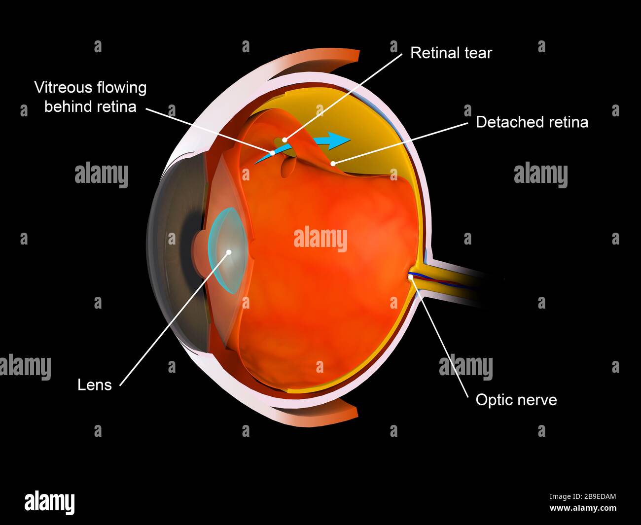 Eyeball retina cross section hi-res stock photography and images - Alamy