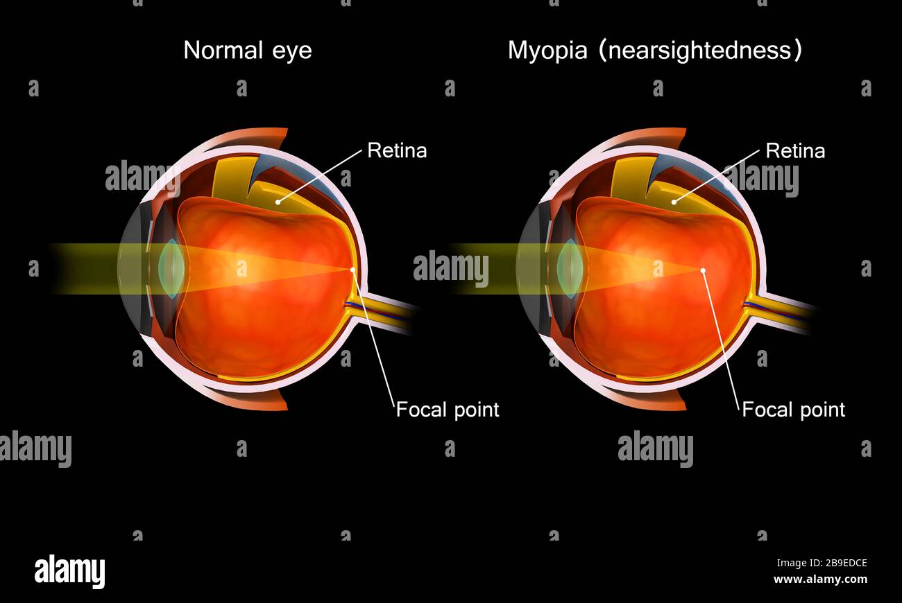 Comparison of a normal eye and an eye with myopia Stock Photo - Alamy