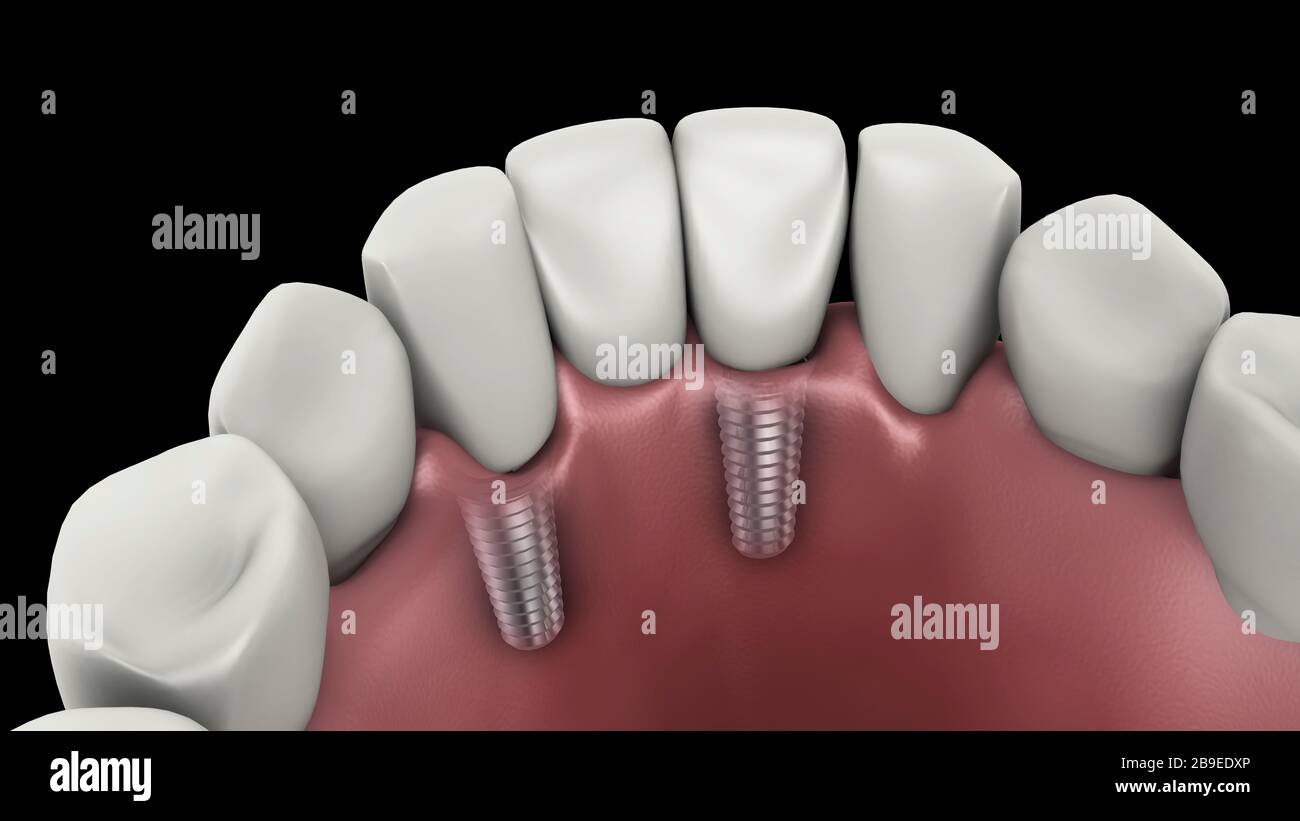 Medical illustration of a tooth implant Stock Photo - Alamy