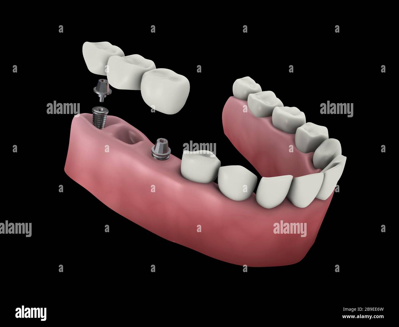 Medical illustration of a dental bridge Stock Photo - Alamy