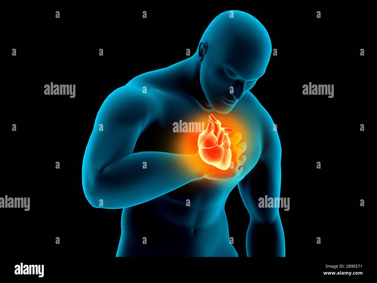 Medical illustration of a heart attack Stock Photo - Alamy