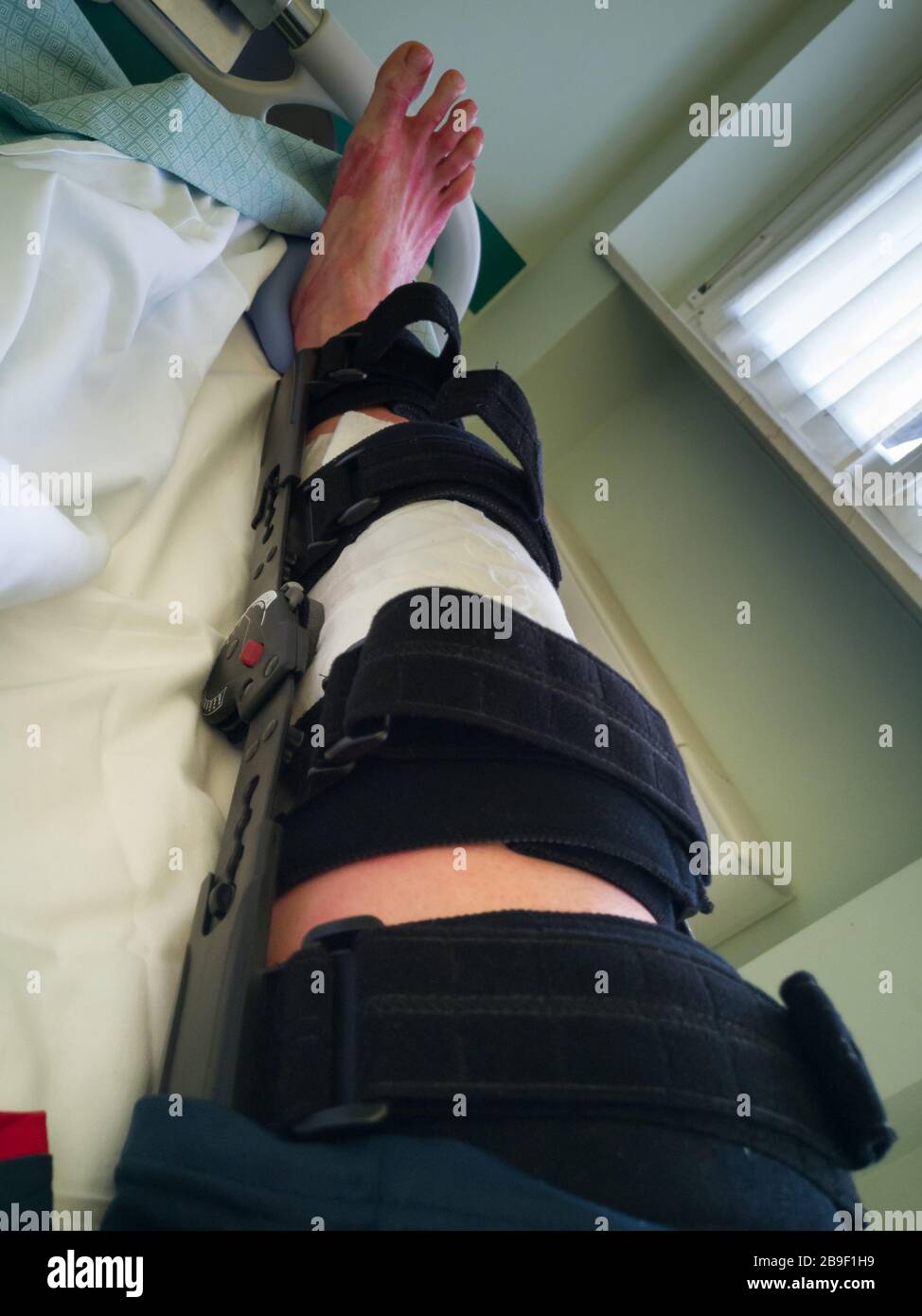 Human Leg with Patches and Orthopedic Brace After Anterior Cruciate ...