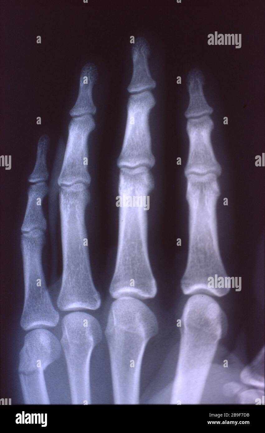 X-ray image, man, hand with bones and joints Stock Photo - Alamy
