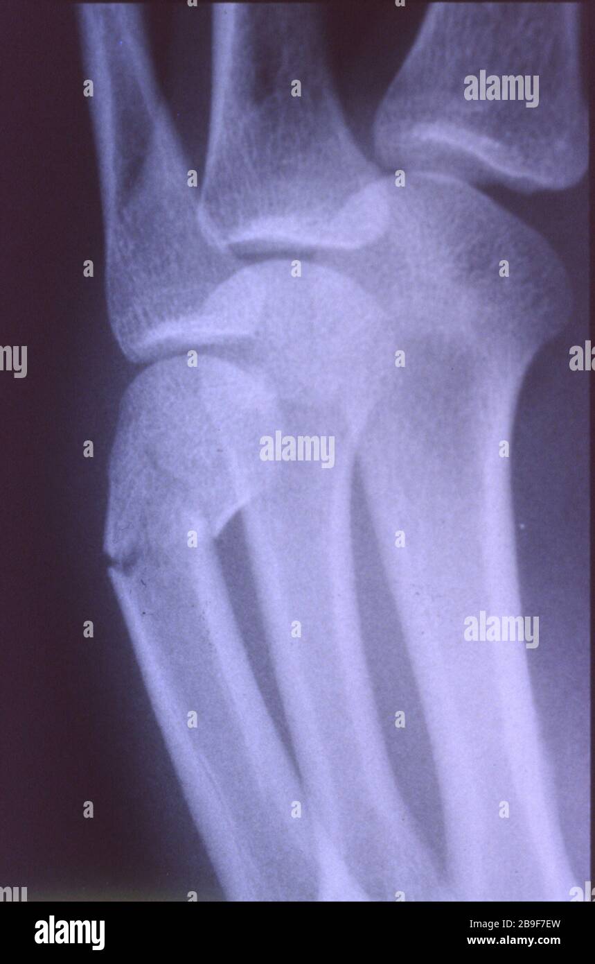 X-ray image, man, hand with bones and joints Stock Photo - Alamy