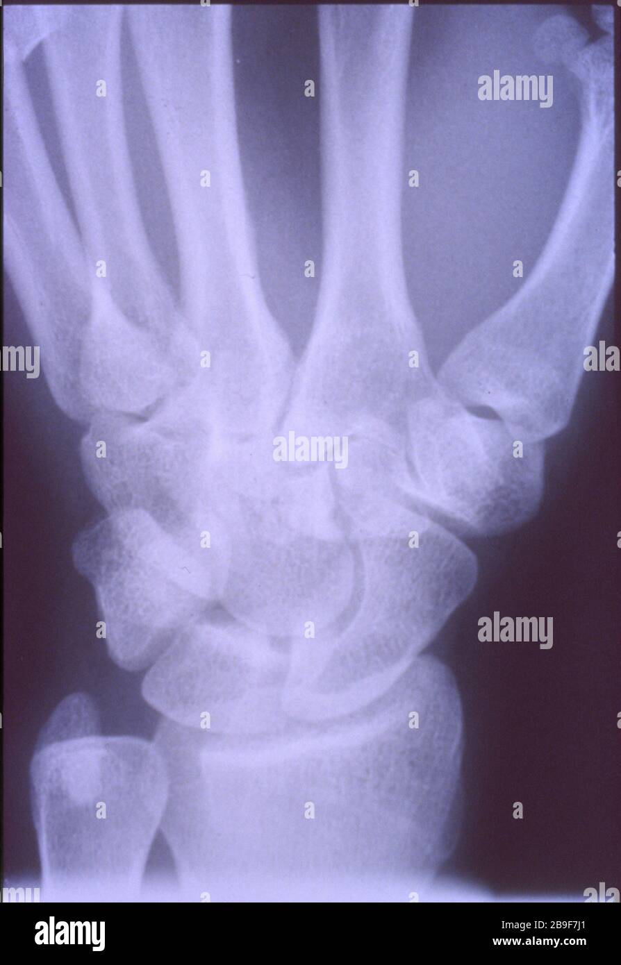 X-ray image, man, hand with bones and joints Stock Photo - Alamy