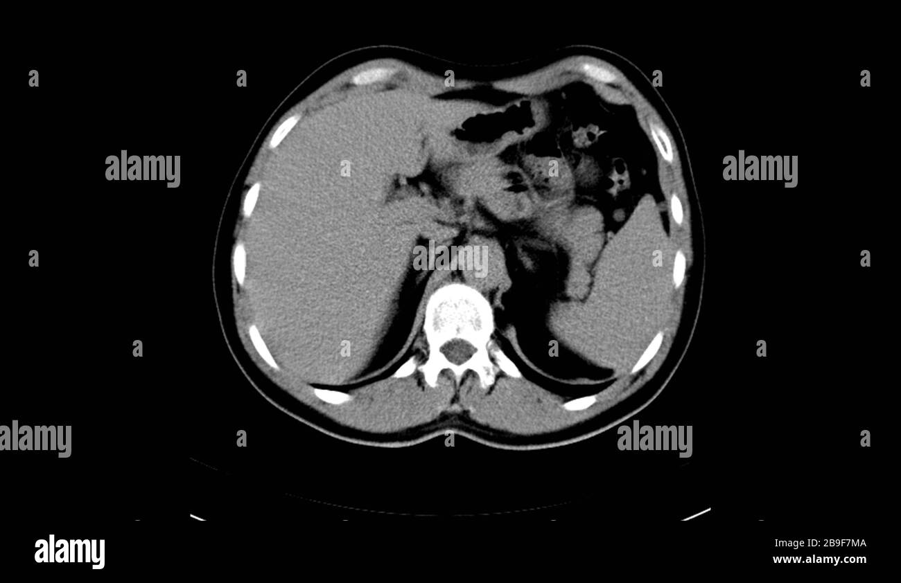 Abdomen human, man, CT scan Stock Photo - Alamy