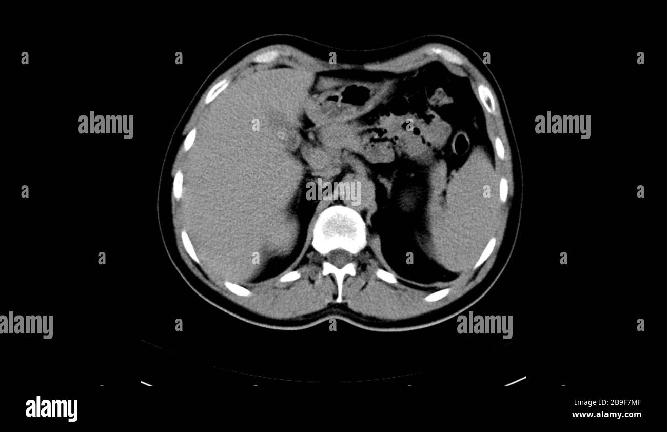 Abdomen human, man, CT scan Stock Photo - Alamy