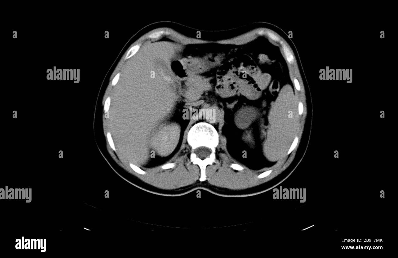 Abdomen human, man, CT scan Stock Photo - Alamy