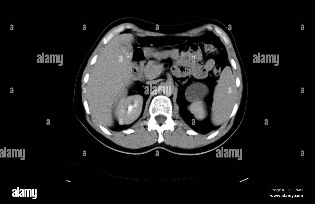 Abdomen human, man, CT scan Stock Photo - Alamy