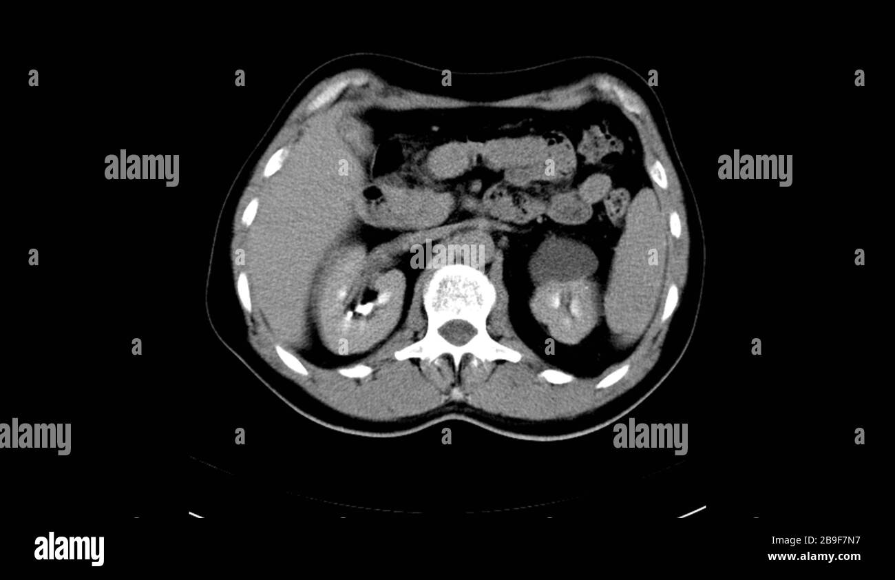 Abdomen ct scan examination Black and White Stock Photos & Images - Alamy