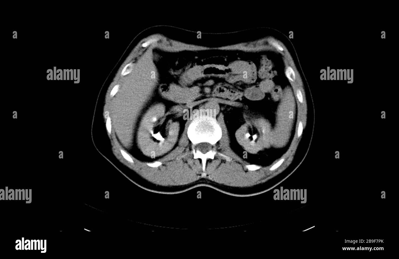 Abdomen ct scan examination Black and White Stock Photos & Images - Alamy