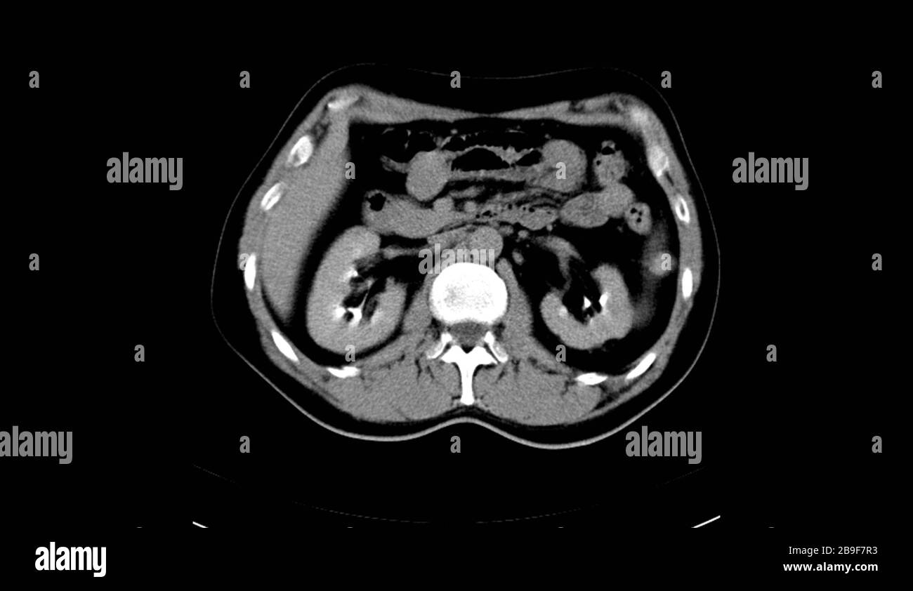 Abdomen human, man, CT scan Stock Photo - Alamy