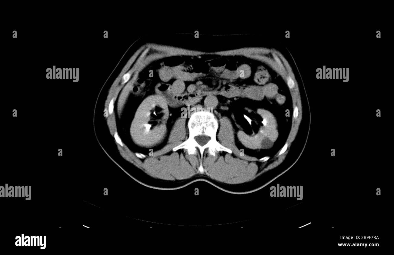 Abdomen human, man, CT scan Stock Photo - Alamy