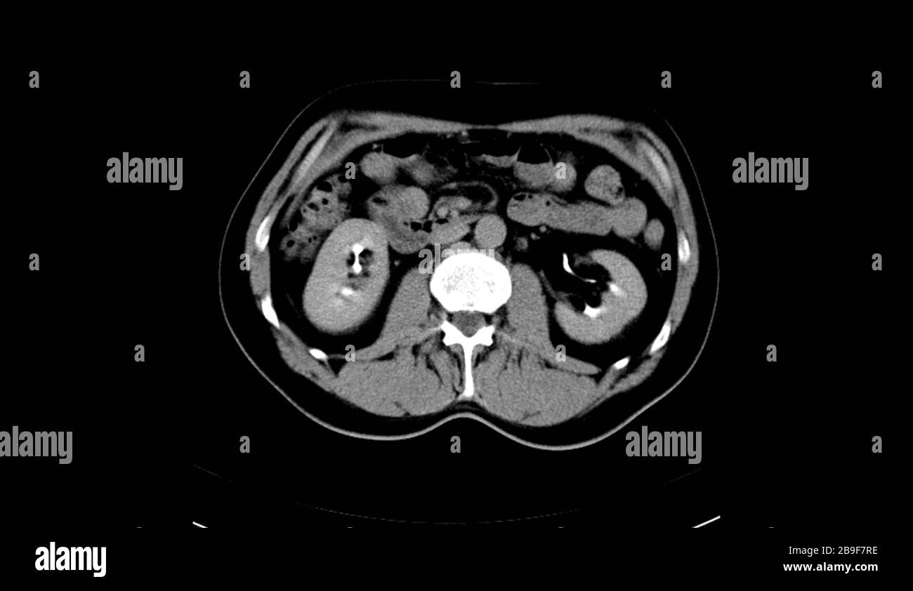 Abdomen ct scan examination hi-res stock photography and images - Alamy Abdomen ct scan examination hi-res stock photography and images - Alamy