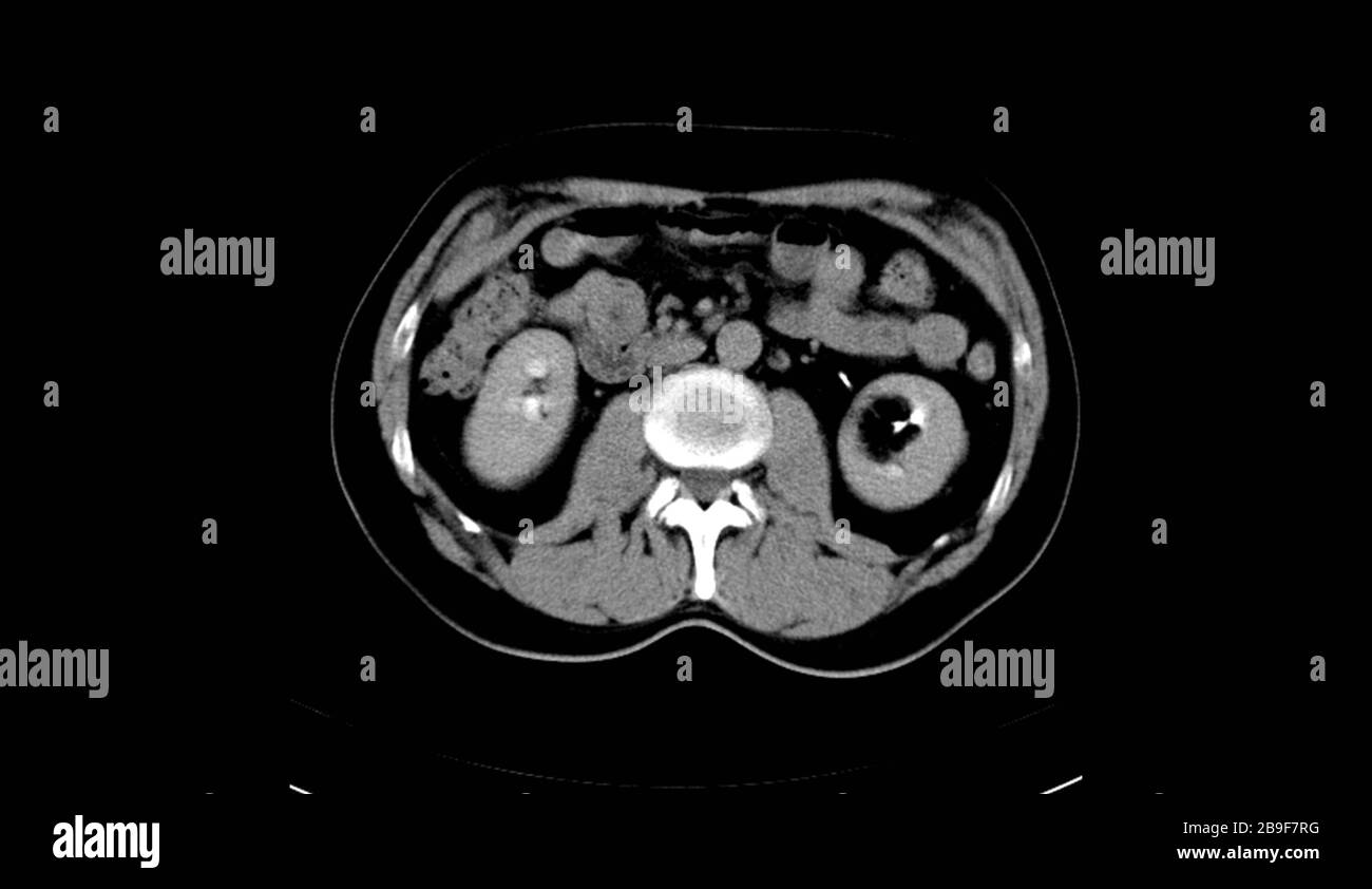 Abdomen human, man, CT scan Stock Photo - Alamy