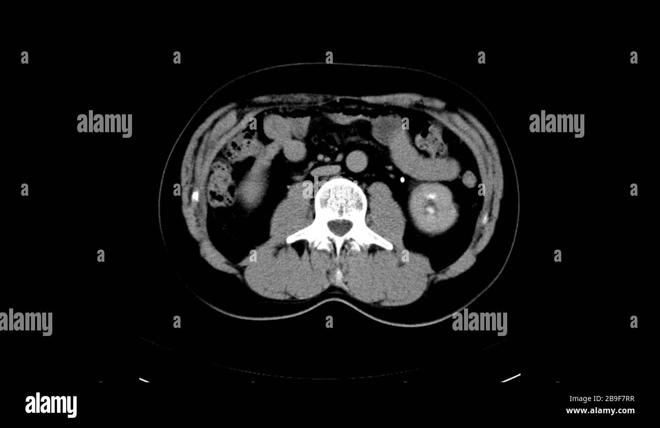 Abdomen human, man, CT scan Stock Photo - Alamy