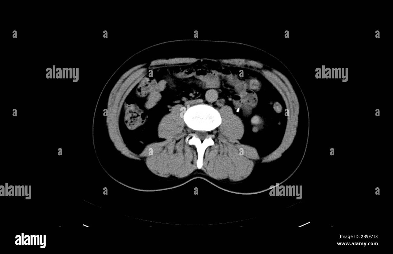 Abdomen human, man, CT scan Stock Photo - Alamy