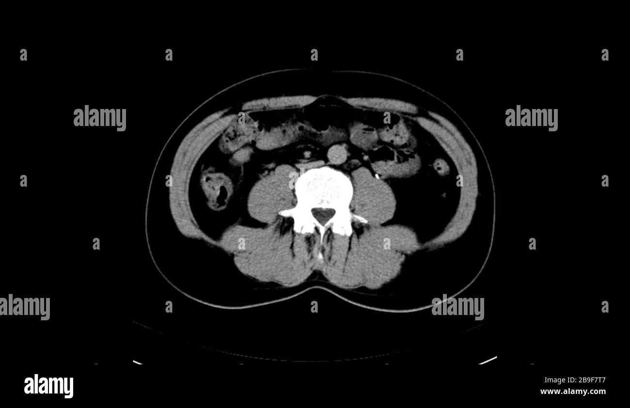Abdomen human, man, CT scan Stock Photo - Alamy